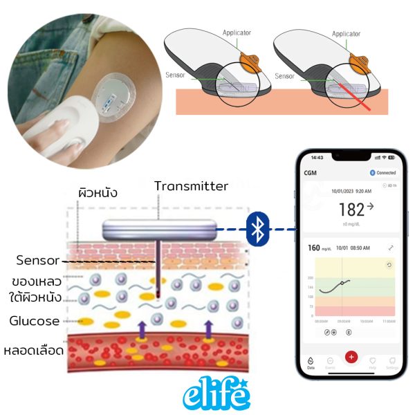 Continuous Glucose Monitoring เครื่องวัดน้ำตาลในเลือด CGM | อีไลฟ์ ...