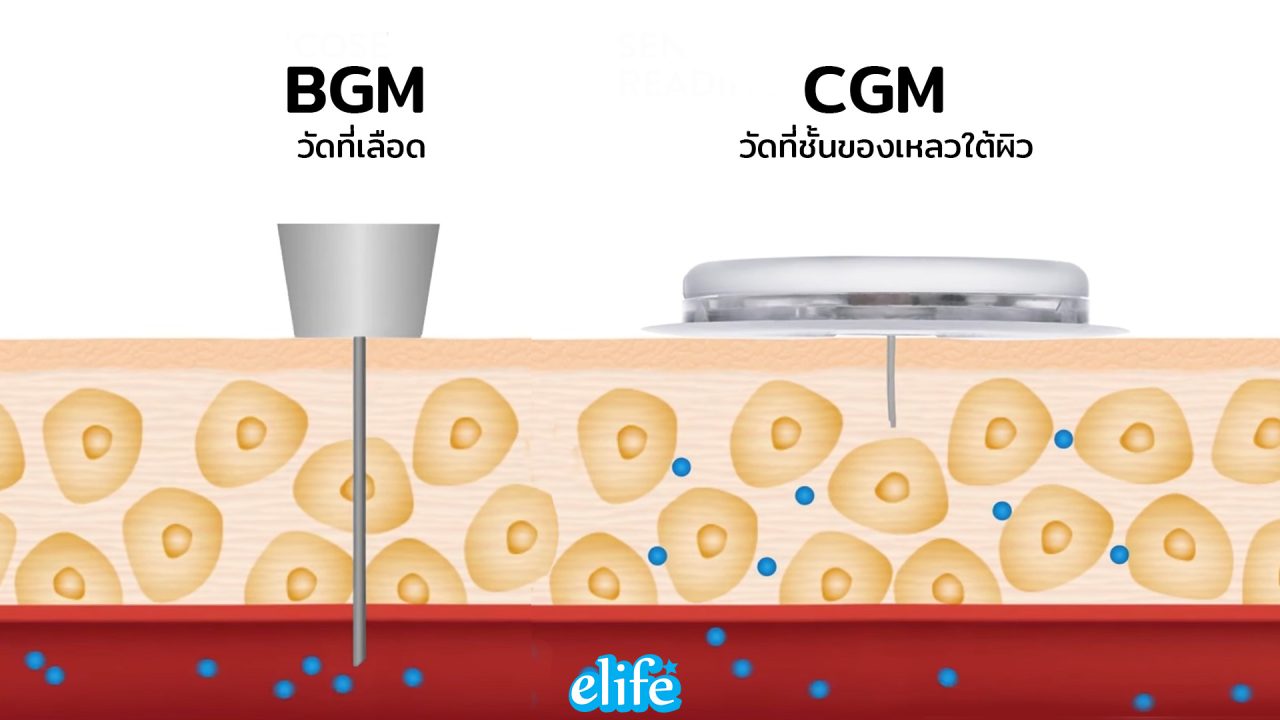 ทำไมน้ำตาลไม่เท่ากัน เจาะปลายนิ้ว vs CGM? | อีไลฟ์ สินค้าสุขภาพ | Ergonomics | เพื่อชีวิตที่ดีขึ้น