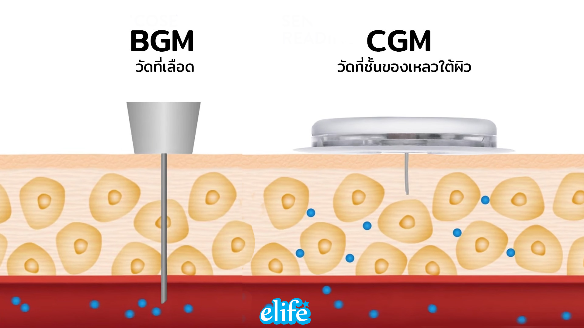 ทำไมน้ำตาลไม่เท่ากัน เจาะปลายนิ้ว vs CGM? | อีไลฟ์ สินค้าสุขภาพ ...